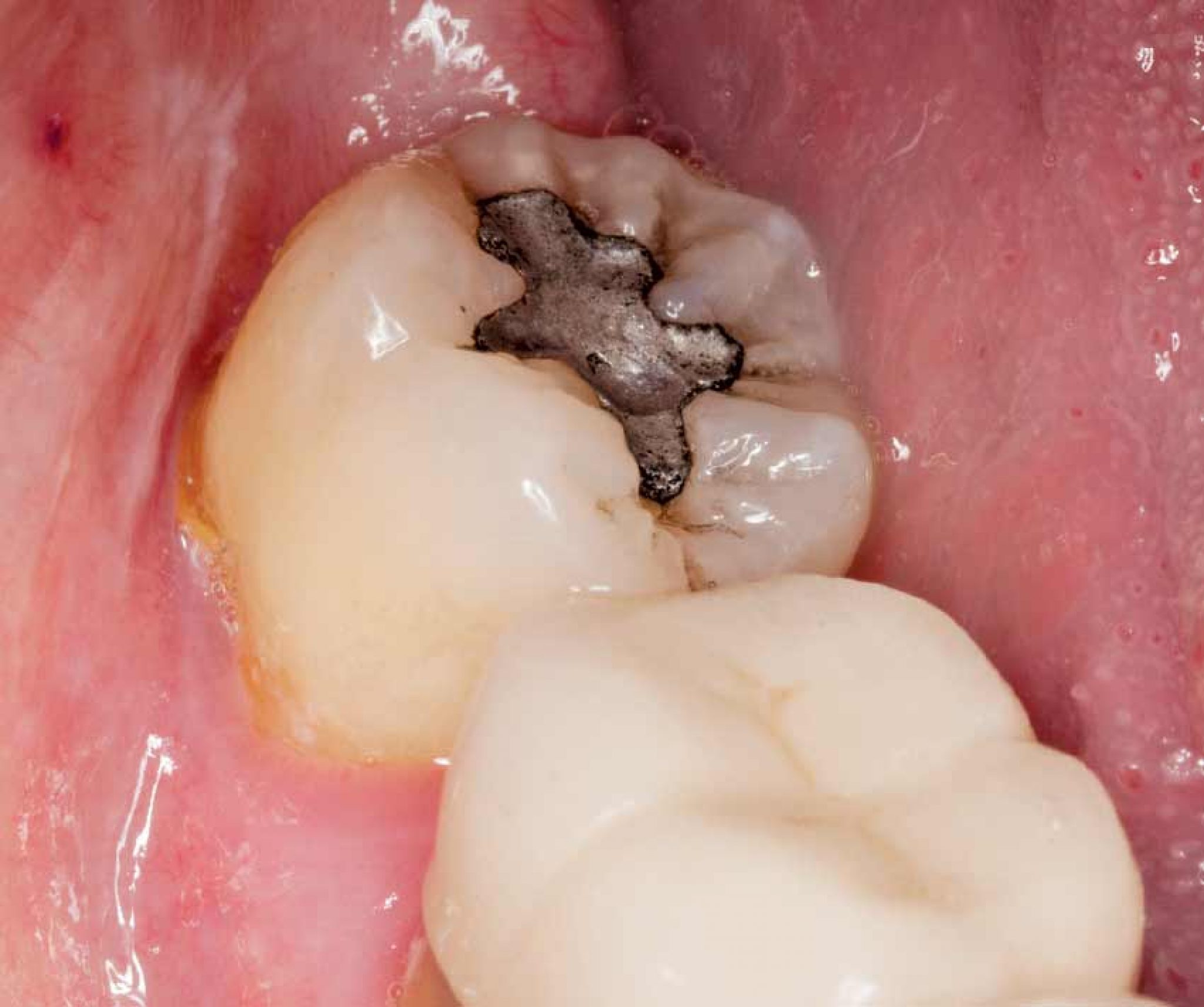 Why Should you Choose White Non-Metal Dental Fillings - 2024 Guide ... Why Should you Choose White Non-Metal Dental Fillings - 2024 Guide ...