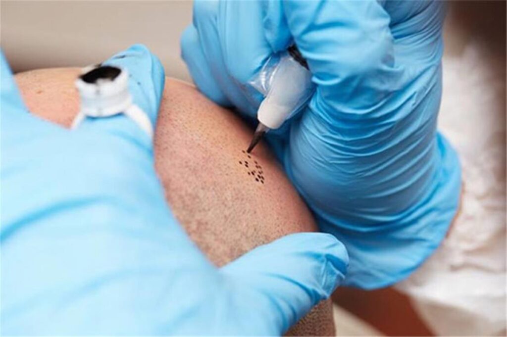 Scalp Micropigmentation Training: Mastering Technique and Precision - WebSta.ME